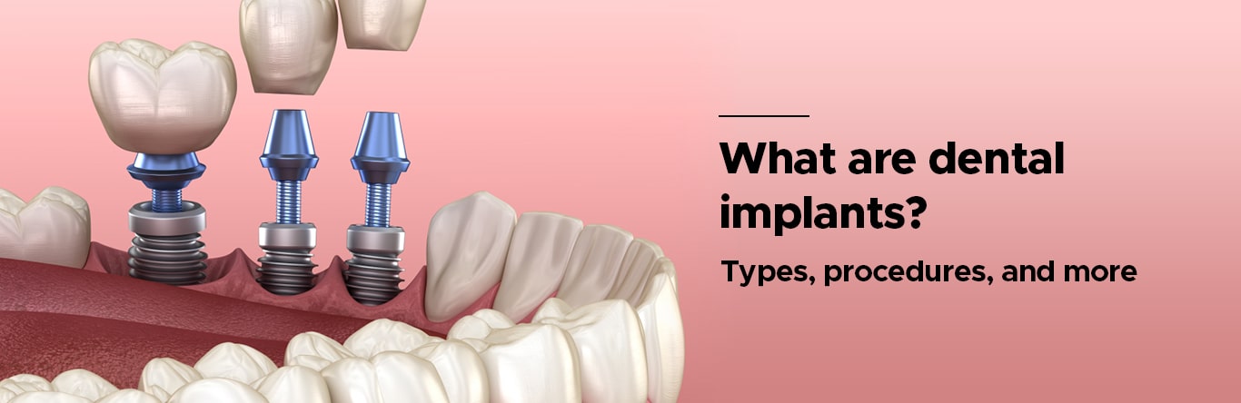 Dental Implants:Types, Procedures, and More - IVY League Dental