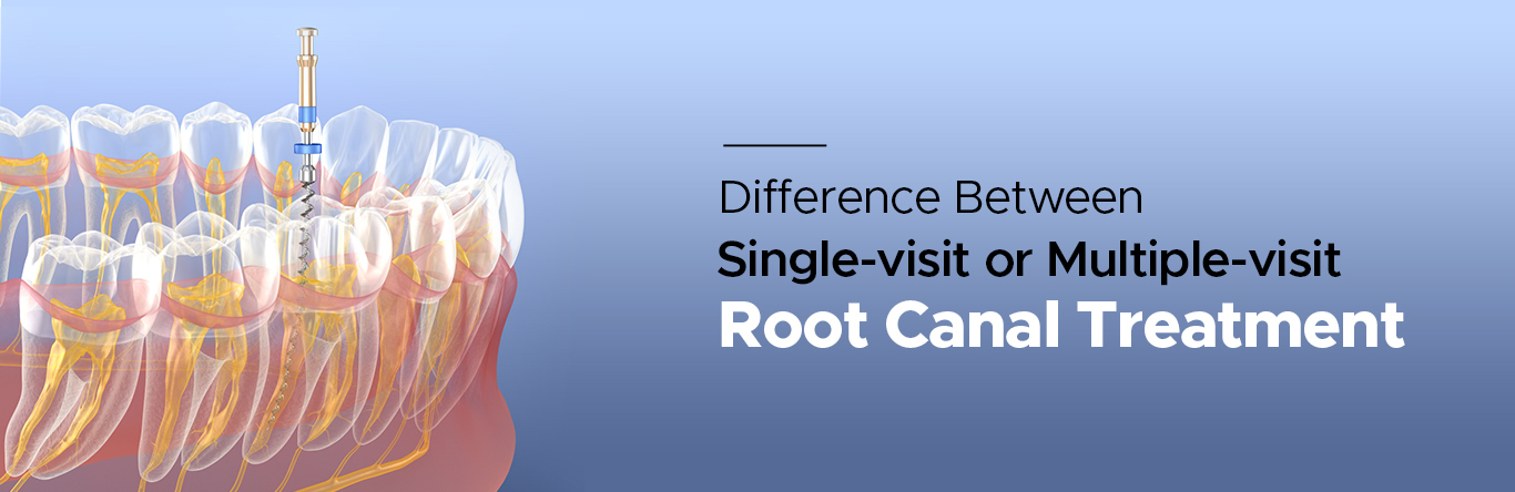 Difference Between Single-visit or Multiple-visit Root Canal Treatment