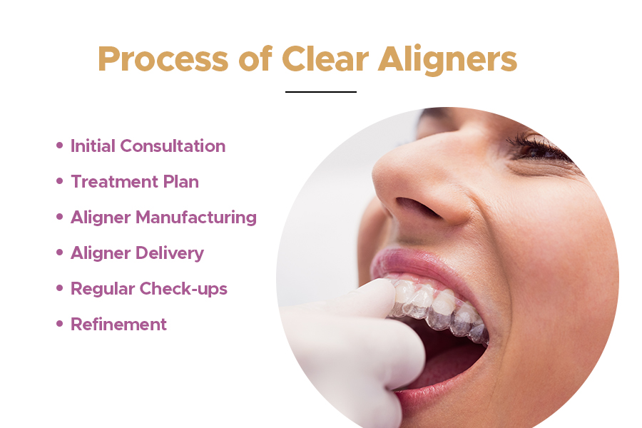 How to Get Aligners Treatment - A Complete Guide